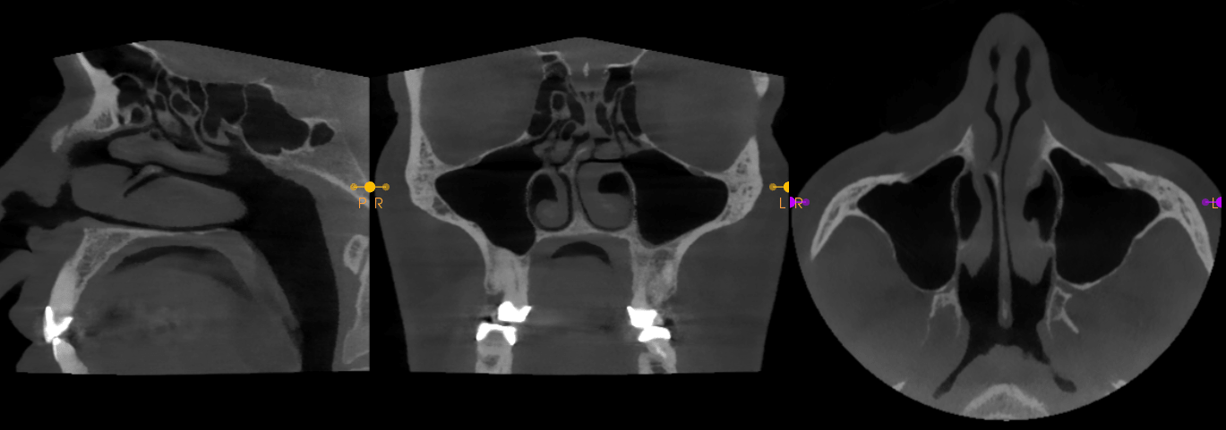 Tomografia stożkowa CBCT, tomografia szczęki Białystok, tomografia ...
