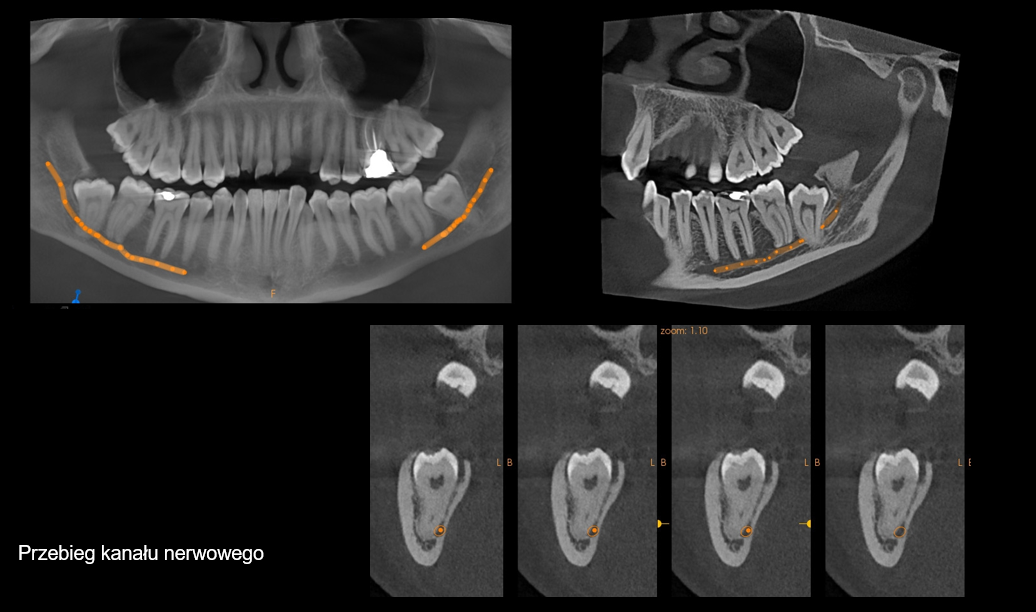 Tomografia stożkowa CBCT, tomografia szczęki Białystok, tomografia ...
